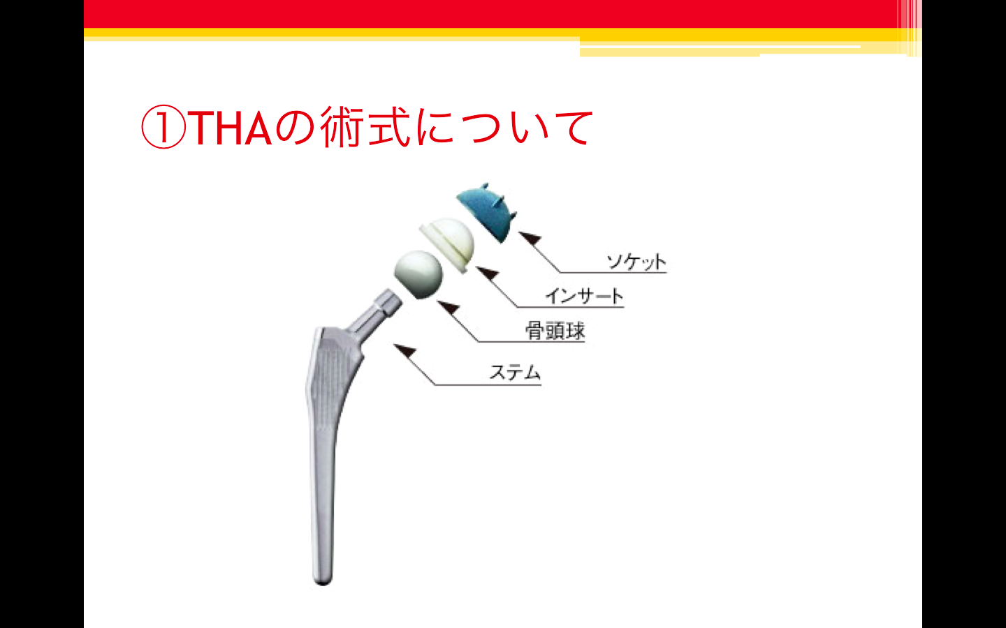 人工股関節全置換術（THA）の術式と痛みとXp評価とは？THAの治療に対する考え方！ | RehaRock〜リハロック〜